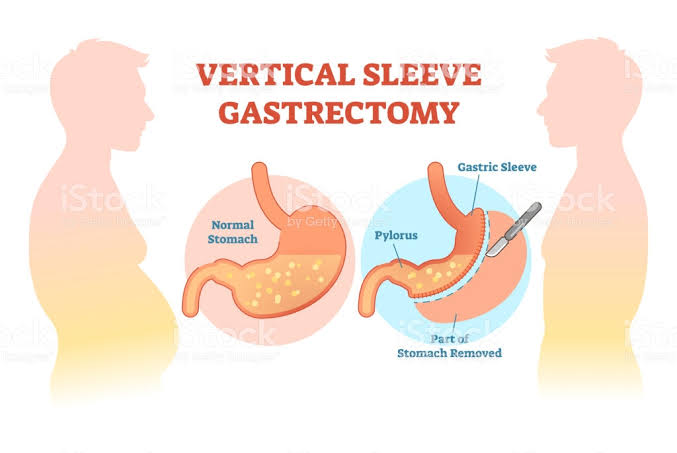 Gastrectomia vertical: o que é e para quem é indicado - Osasco Notícias